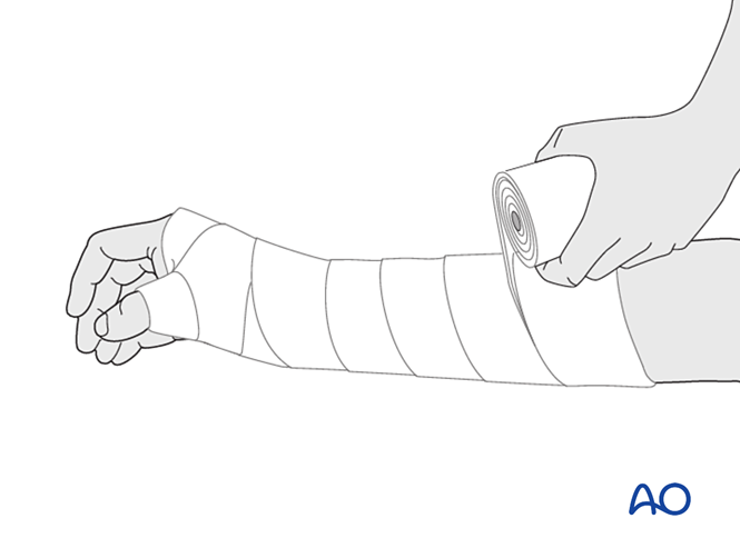 Immobilization with a cast