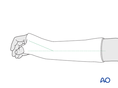 Immobilization with a cast