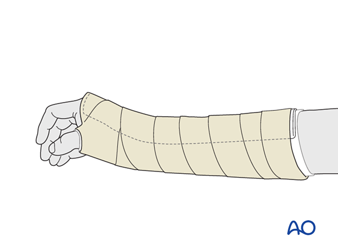 Hook excision for Hamate hook fracture
