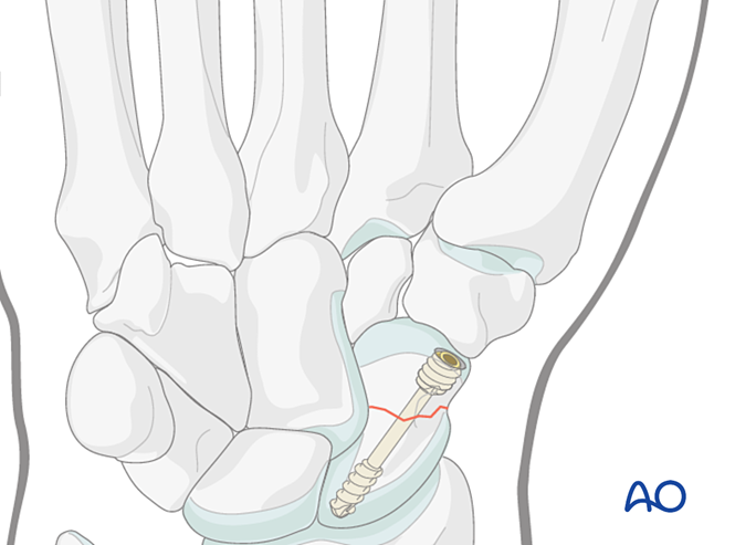 Percutaneous screw fixation through a palmar approach for Scaphoid ...