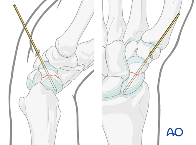 Percutaneous screw fixation through a palmar approach for Scaphoid ...