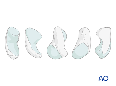 ORIF through dorsal approach - Antegrade screw fixation for Proximal ...