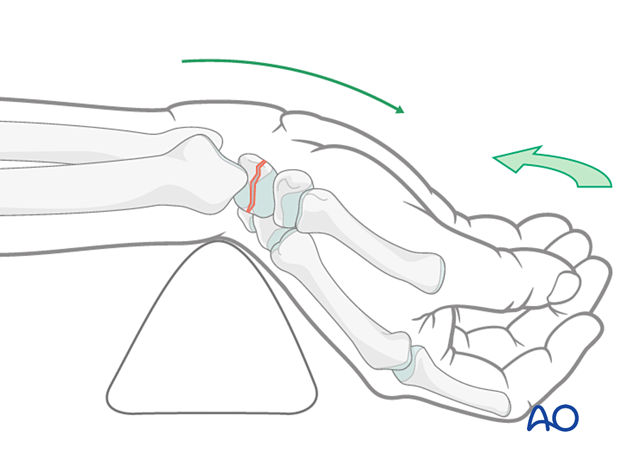 Percutaneous Screw Fixation Through A Palmar Approach For Scaphoid