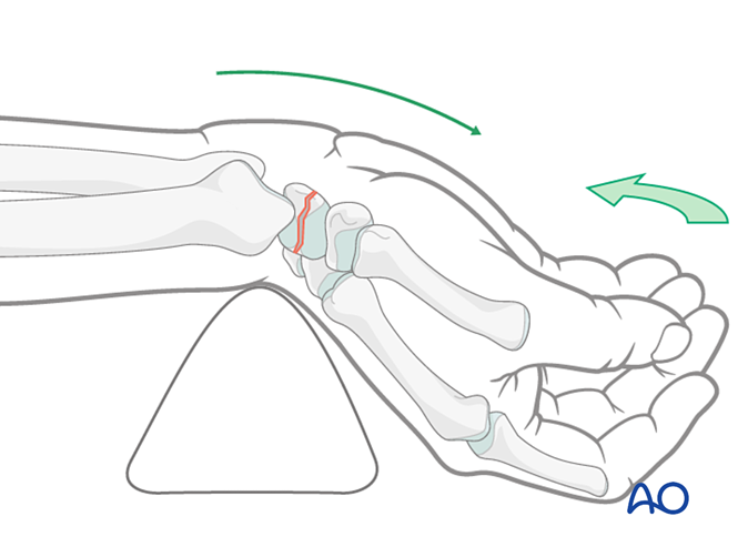 Percutaneous screw fixation through a palmar approach for Scaphoid ...