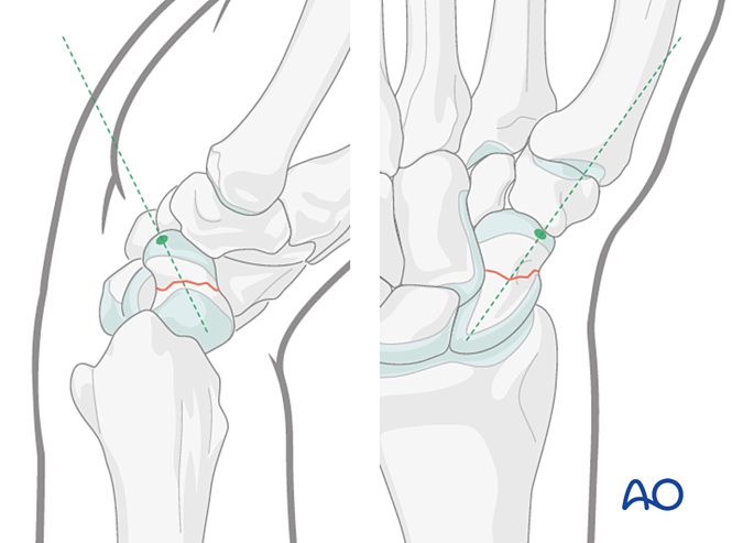 Percutaneous screw fixation through a palmar approach for Scaphoid ...