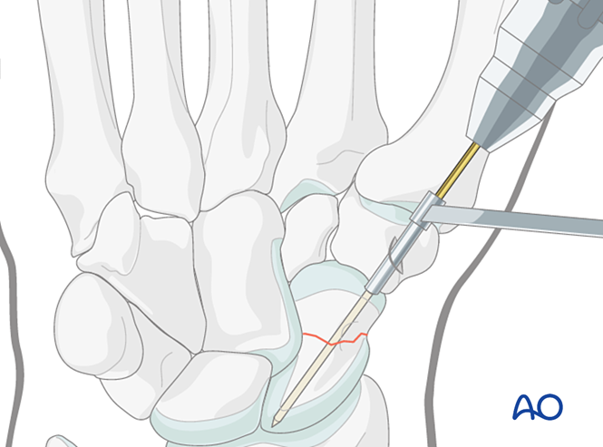 Percutaneous screw fixation through a palmar approach for Scaphoid ...