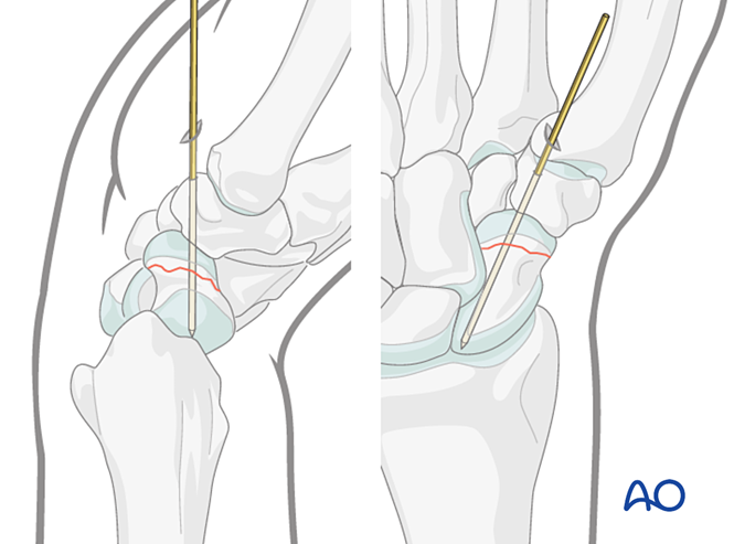 Percutaneous screw fixation through a palmar approach for Scaphoid ...