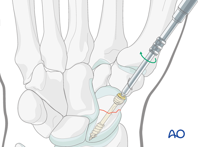 Percutaneous screw fixation through a palmar approach for Scaphoid ...