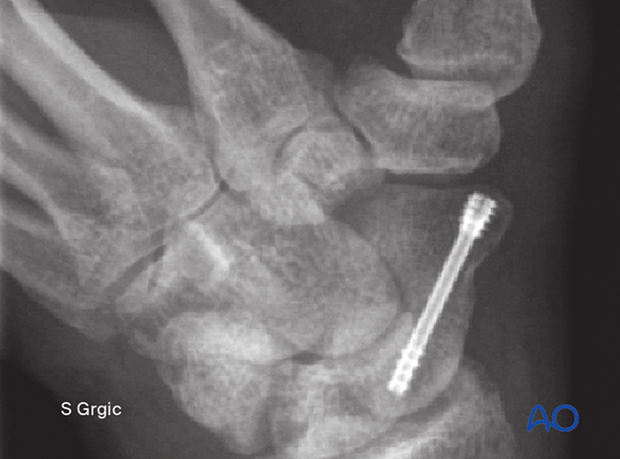 Percutaneous Screw Fixation Through A Palmar Approach For Scaphoid