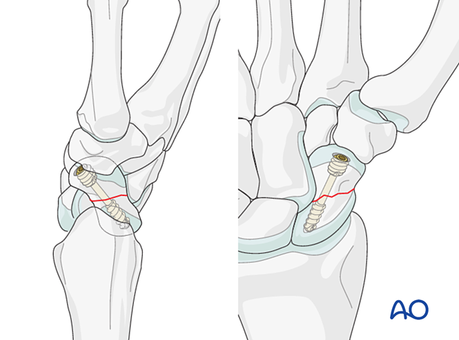 ORIF through dorsal approach - Antegrade screw fixation for Scaphoid ...