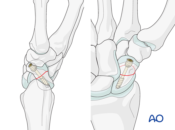 ORIF through palmar approach - Retrograde screw fixation for Scaphoid ...