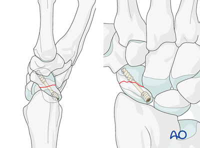 ORIF through dorsal approach - Antegrade screw fixation for Scaphoid ...