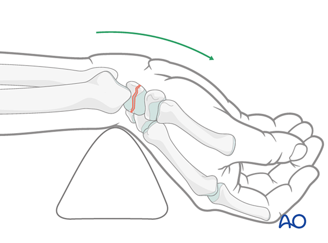 ORIF - Palmar plating for Scaphoid waist fracture