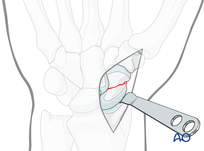 ORIF through palmar approach - Retrograde screw fixation for Scaphoid ...