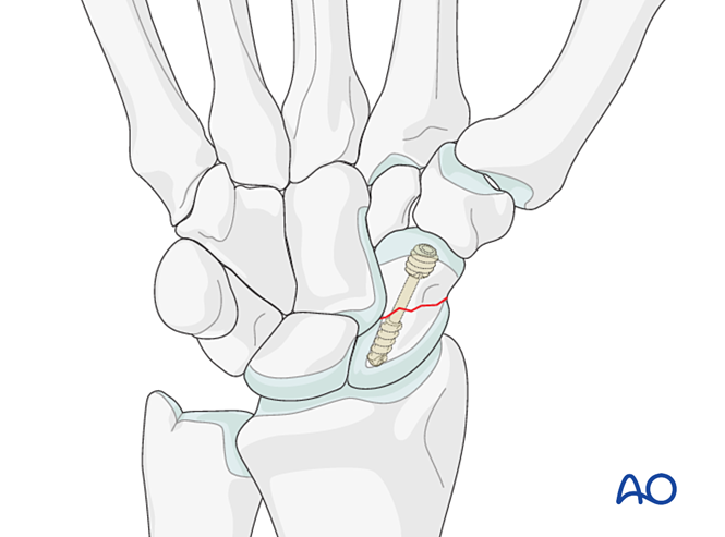 ORIF through palmar approach - Retrograde screw fixation for Scaphoid ...