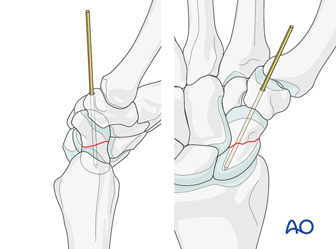 ORIF through palmar approach - Retrograde screw fixation for Scaphoid ...