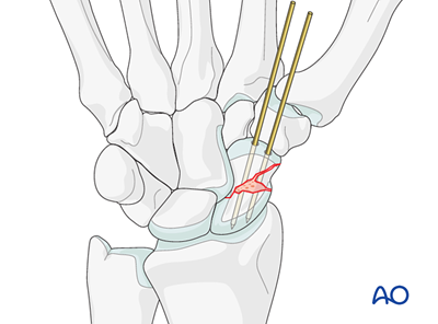 ORIF through palmar approach - Retrograde screw fixation for Scaphoid ...