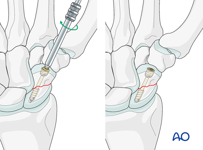ORIF through palmar approach - Retrograde screw fixation for Scaphoid ...