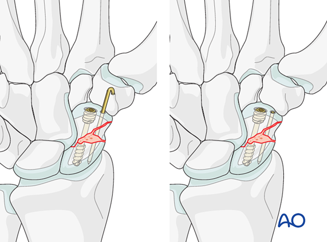 ORIF through palmar approach - Retrograde screw fixation for Scaphoid ...