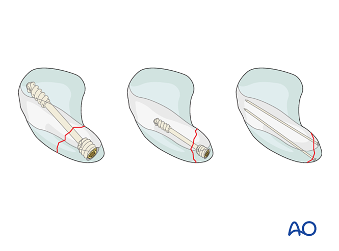 Orif Through Dorsal Approach Antegrade Screw Fixation For Proximal