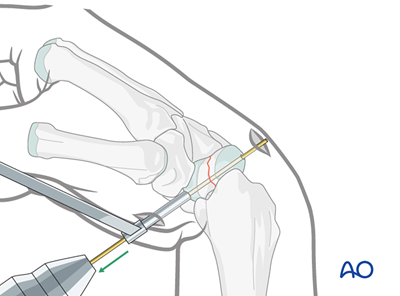 Percutaneous screw fixation with combined approaches for Scaphoid waist ...