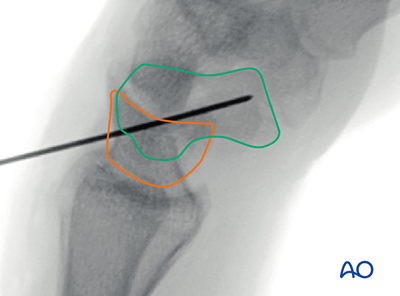 Percutaneous screw fixation with combined approaches for Scaphoid waist ...