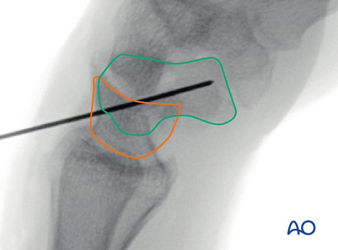 Percutaneous screw fixation with combined approaches for Scaphoid waist ...