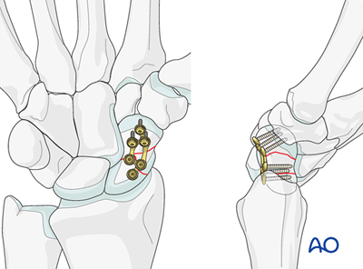ORIF - Palmar plating for Scaphoid waist fracture