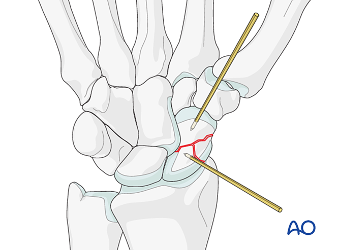 ORIF - Palmar plating for Scaphoid waist fracture