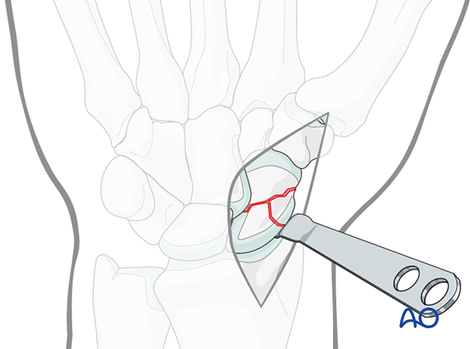 ORIF - Palmar plating for Scaphoid waist fracture