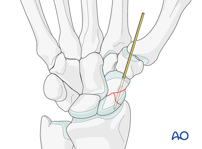 ORIF - Palmar plating for Scaphoid waist fracture