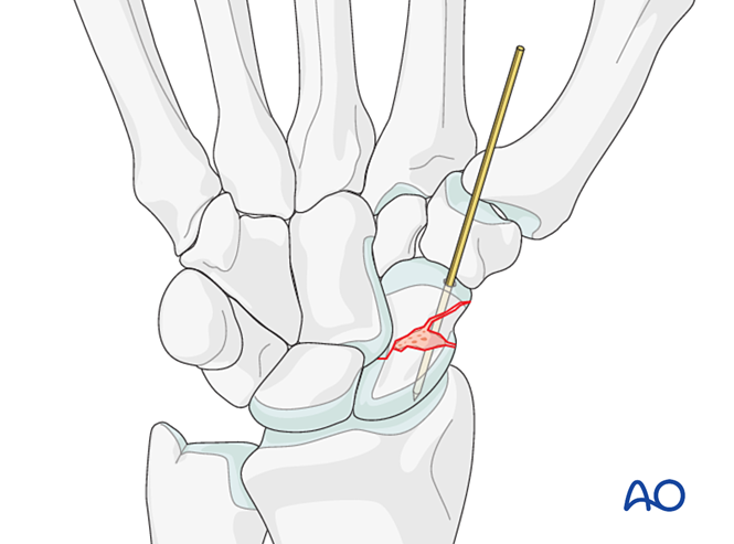 ORIF - Palmar plating for Scaphoid waist fracture