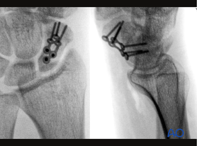 ORIF - Palmar plating for Scaphoid waist fracture