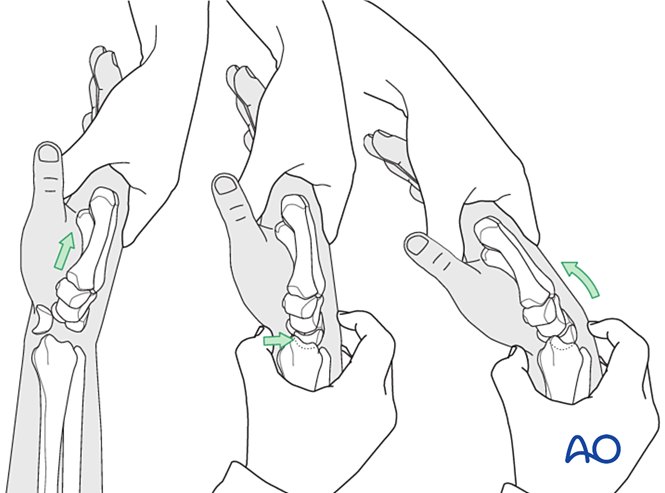 Open reduction - Ligament repair for Lunate dislocation