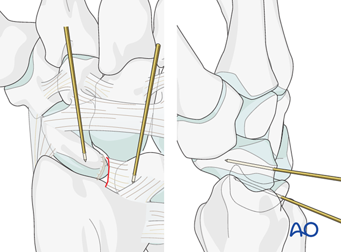 Open reduction - Ligament repair for Lunate dislocation