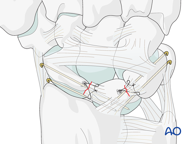 ORIF - Scapholunate and lunotriquetral ligament repair for Lunocapitate ...