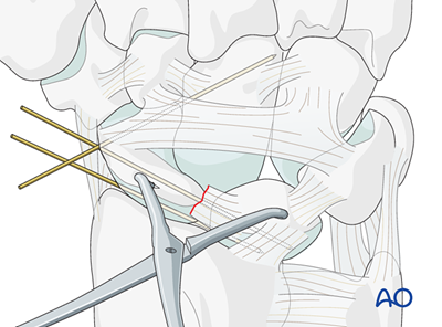 ORIF - Scapholunate reduction and ligament repair for Scapholunate ...