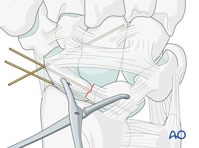 ORIF - Scapholunate reduction and ligament repair for Scapholunate ...