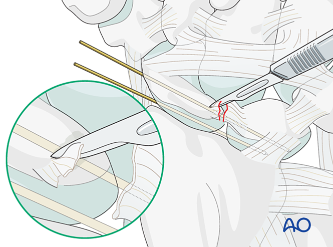 ORIF - Scapholunate reduction and ligament repair for Scapholunate ...