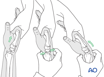 ORIF - Scapholunate reduction and ligament repair for Lunocapitate and ...