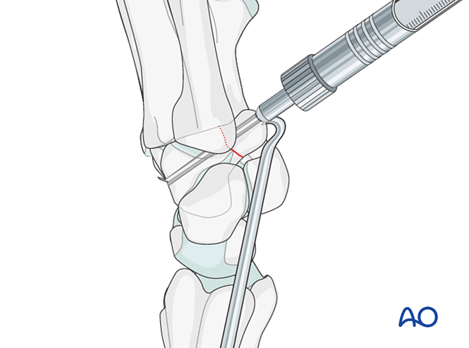 ORIF - Screw fixation for Hamate hook fracture