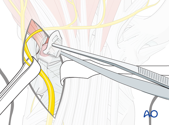 Hook excision for Hamate hook fracture