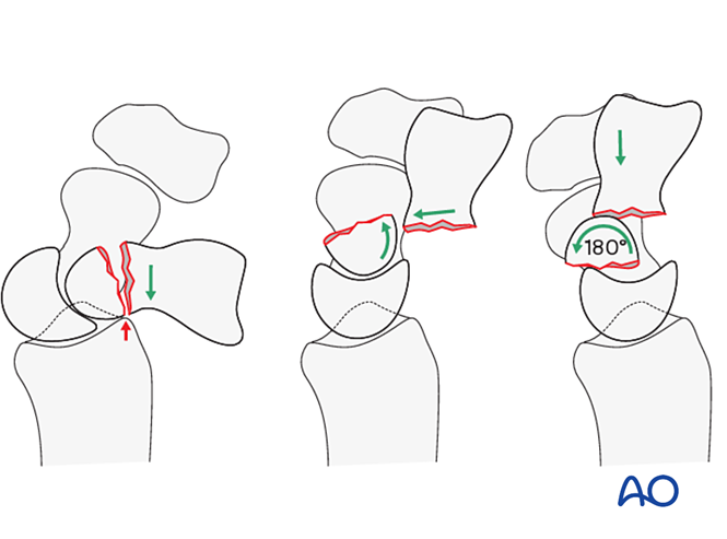 Screw fixation of a capitate fracture
