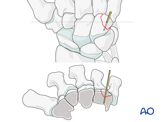 ORIF for Dislocation and fracture-dislocation of the carpometacarpal joints