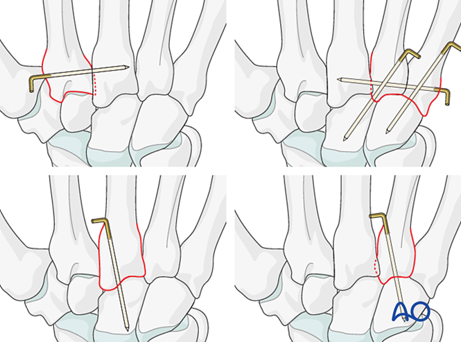 ORIF for Dislocation and fracture-dislocation of the carpometacarpal joints