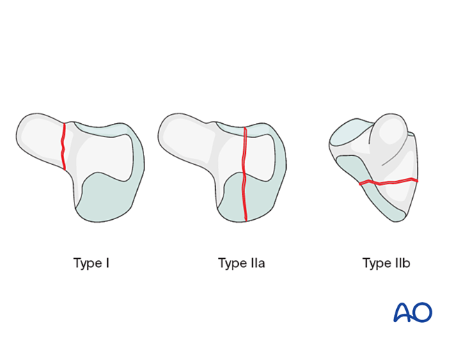 Classifications for fractures of carpal bones