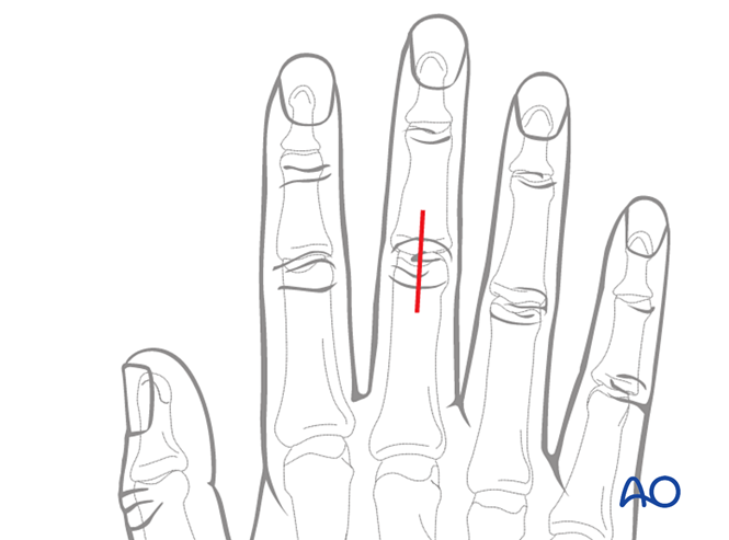 Dorsal approach to the PIP joint