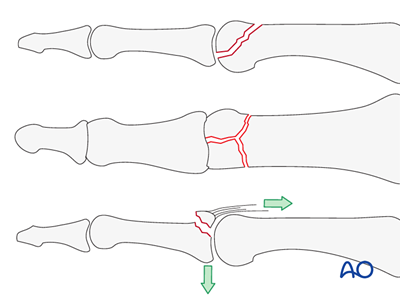 Dorsal approach to the PIP joint