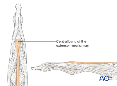 Dorsal approaches to the proximal interphalangeal joint