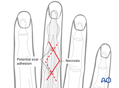 Dorsal approaches to the proximal interphalangeal joint